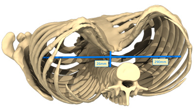 Définition du Pectus Excavatum ou thorax en entonnoir