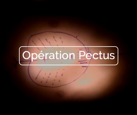 Traitement du Pectus Excavatum avec implant 3D sur-mesure