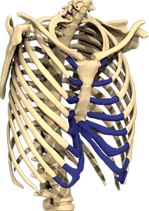Implants 3D pour Pectus Excavatum et Syndrome de Poland | AnatomikModeling