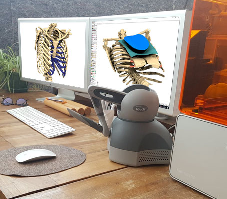 Pectus Excavatum : traitement par implants 3D sur-mesure