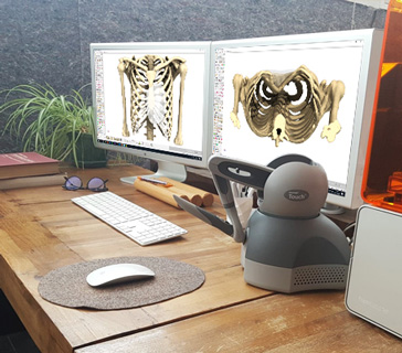 Traitement du Pectus Excavatum avec implant 3D sur-mesure